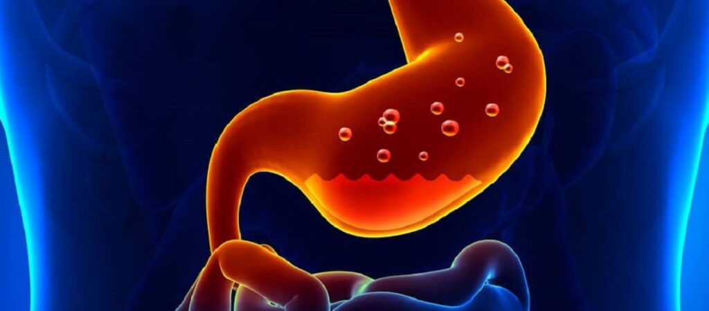 Manejo da Gastroparesia - Nutritotal PRO