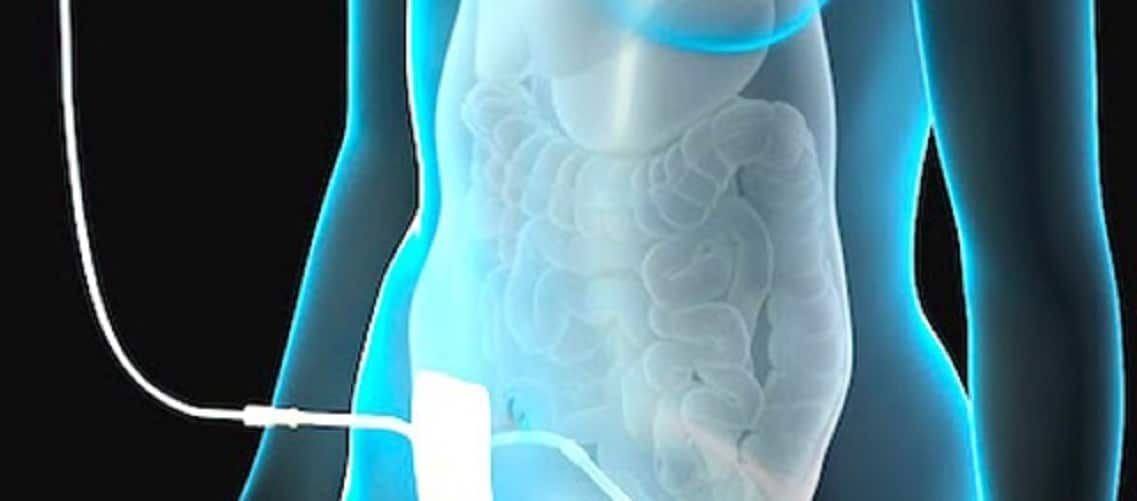 Como realizar orientação nutricional para pacientes em diálise renal ...