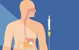 Quando indicar terapia nutricional enteral por ostomias em adultos ...